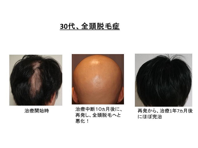 治療中断による再発で全頭脱毛に、そして、根気強く治療して、ほぼ完治！ 患者様からの声・メディア掲載・クリニックからのお知らせ 名古屋kクリニック